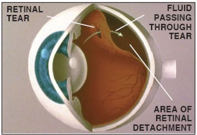 Mohawk Valley Retina - Retinal Detachment - New Hartford, New York