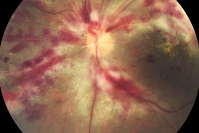 Retinitis - Mohawk Valley Retina