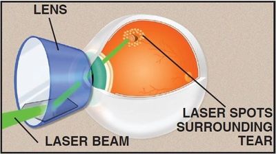 Mohawk Valley Retina - Retinopexy - New Hartford, New York