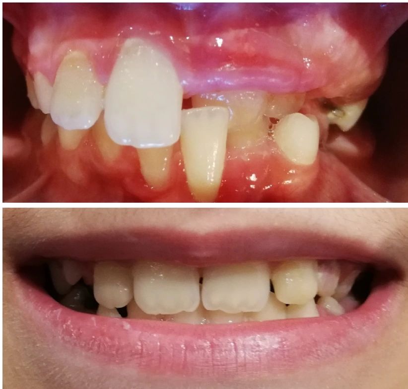 Permanent teeth that erupt in back position