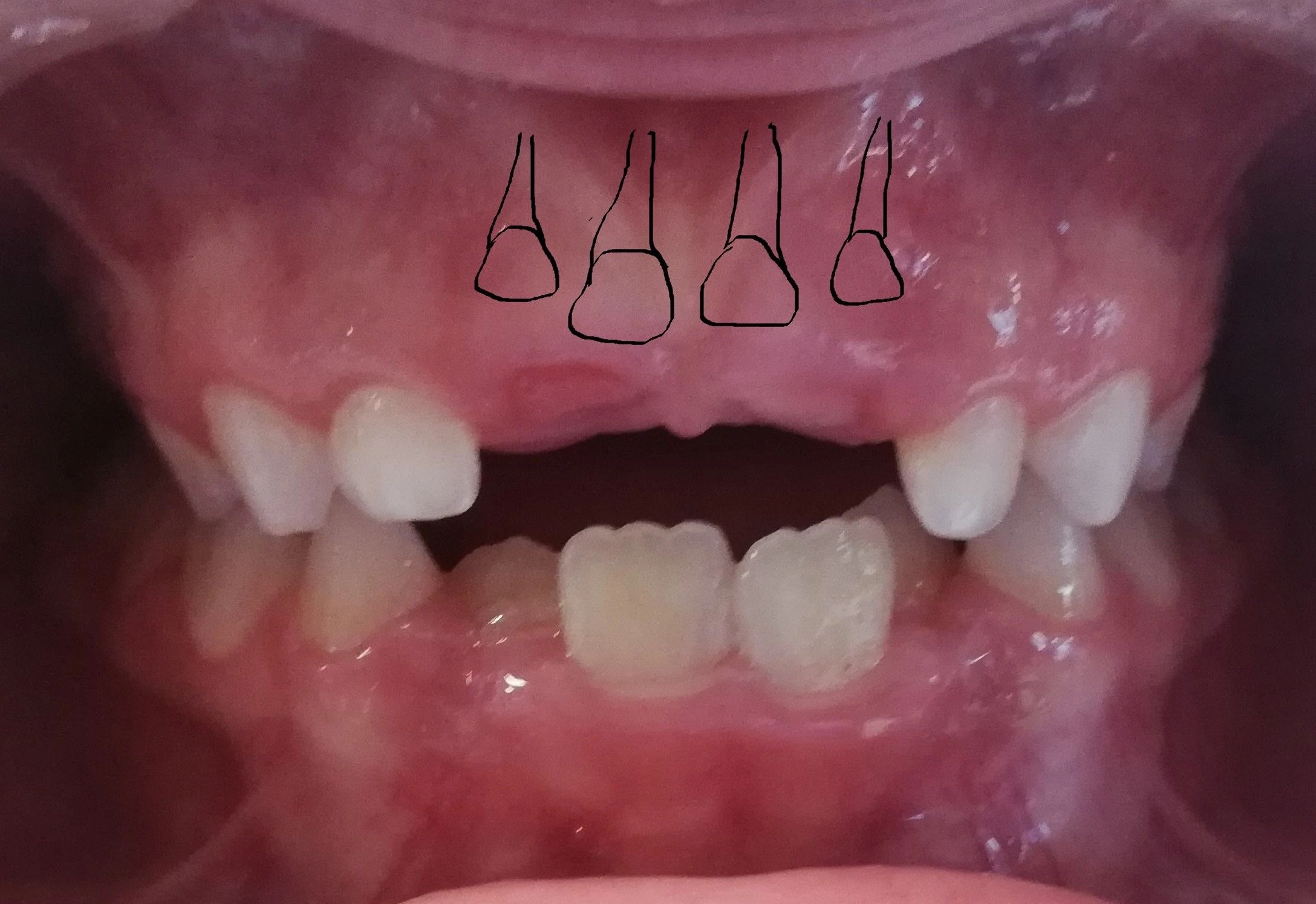 Delayed Eruption of the Anterior Teeth