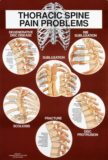 Thoracic Spine Diagnosis (Mid-Spine Pain Conditions) (2'x3') - #25