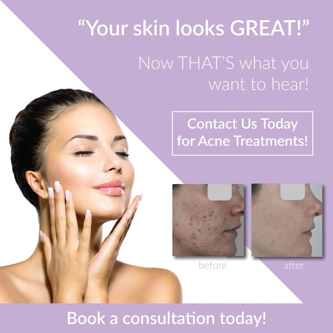 SharpLight Laser Technology - Acne